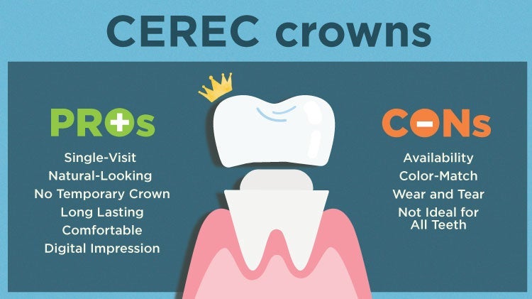 CEREC Crowns: Same Day Crowns Pros & Cons | Smile Generation